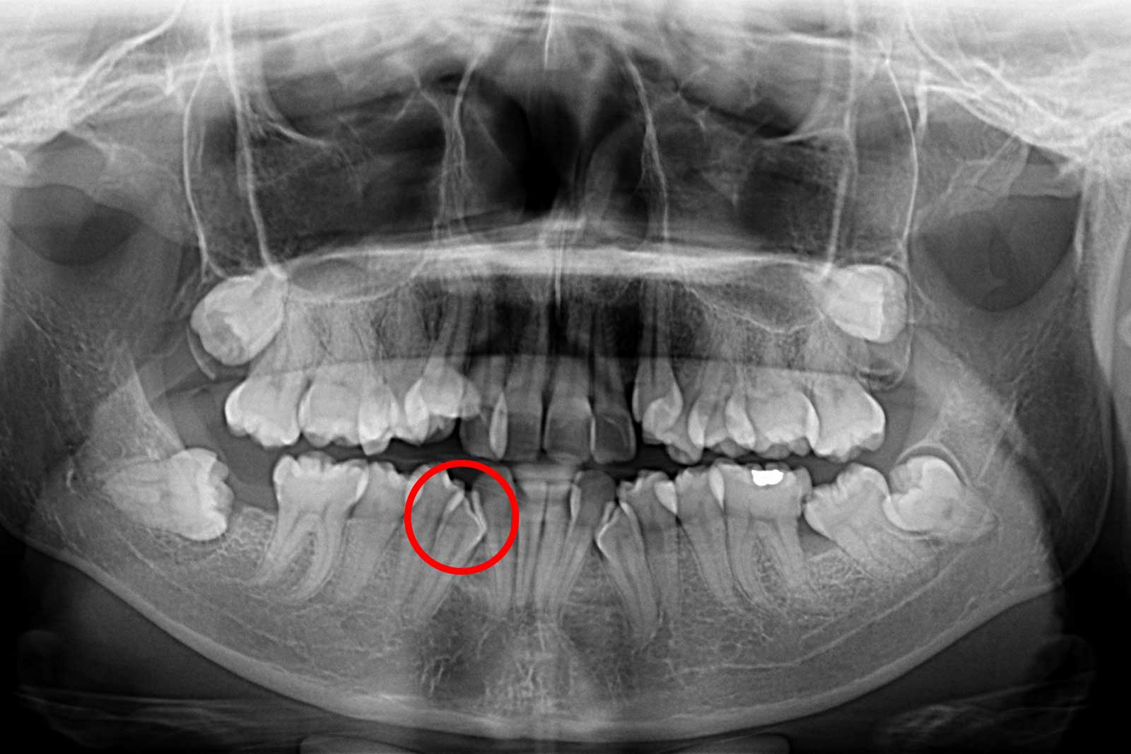 Impacted Canine Treatment in St. Louis | Periodontal Surgical Care